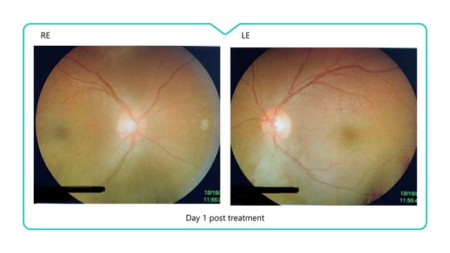 syphilis.pptx | Eye and Vision Conditions | Diseases and Conditions