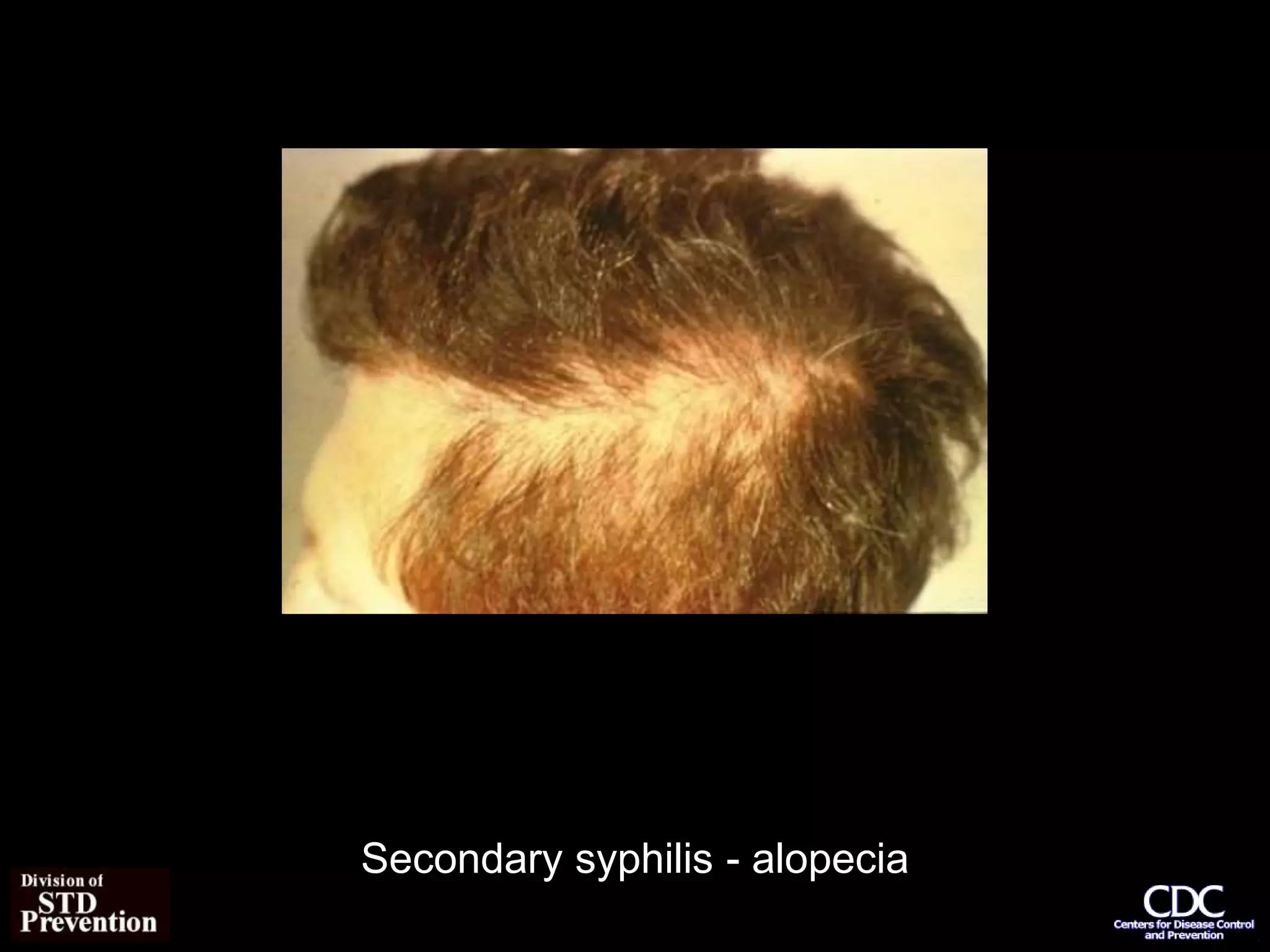 syphilis.ppt