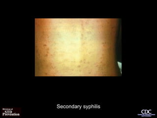 syphilis.ppt