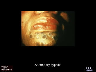 syphilis.ppt