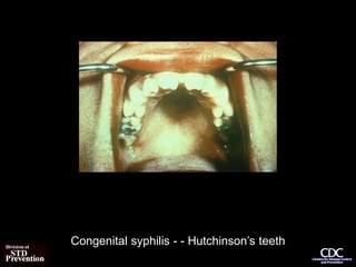 syphilis.ppt