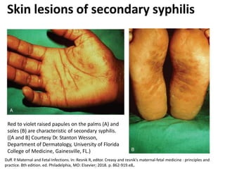 SYPHILIS.pptx