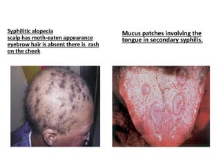 Syphilis inside of the body and effective methods | PPTX