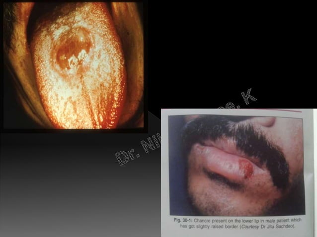 Syphilis | PPTX