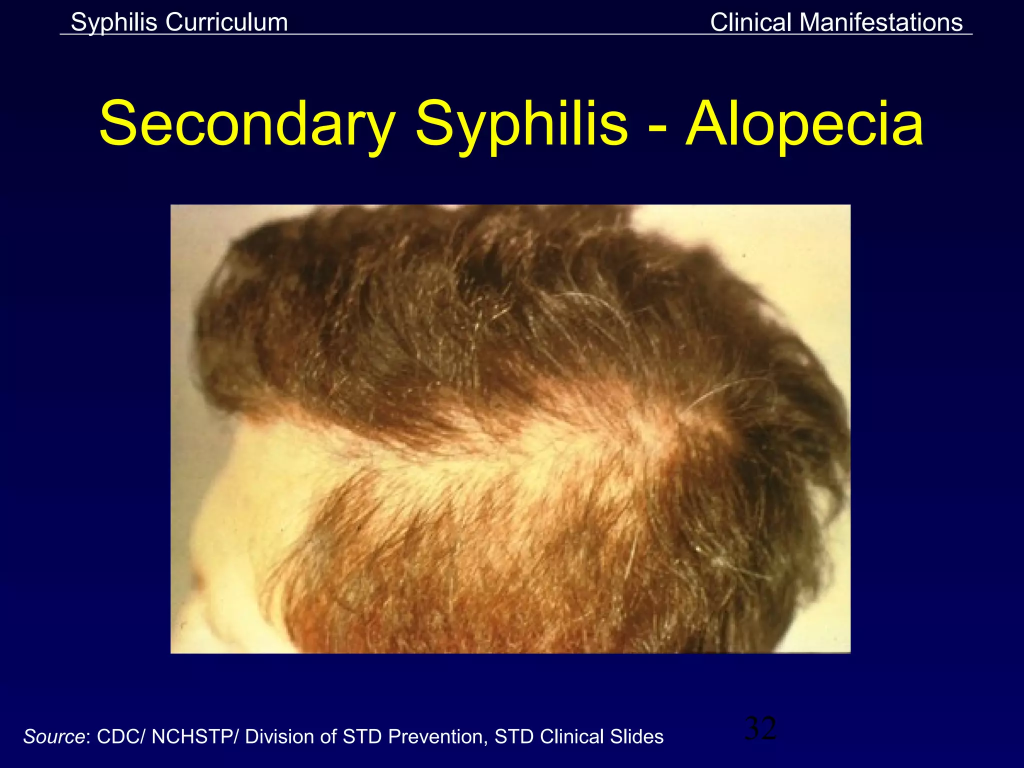 Syphilis slides | PPT