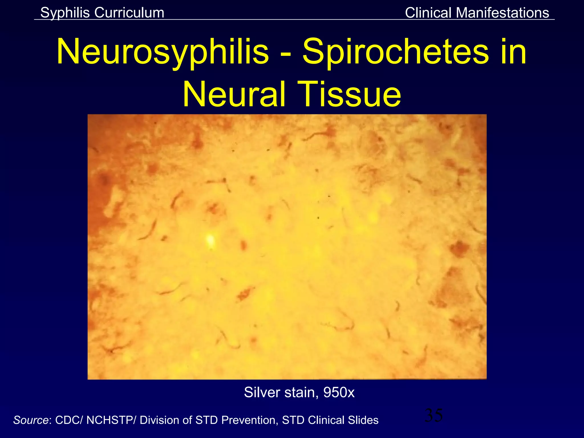 Syphilis slides | PPT