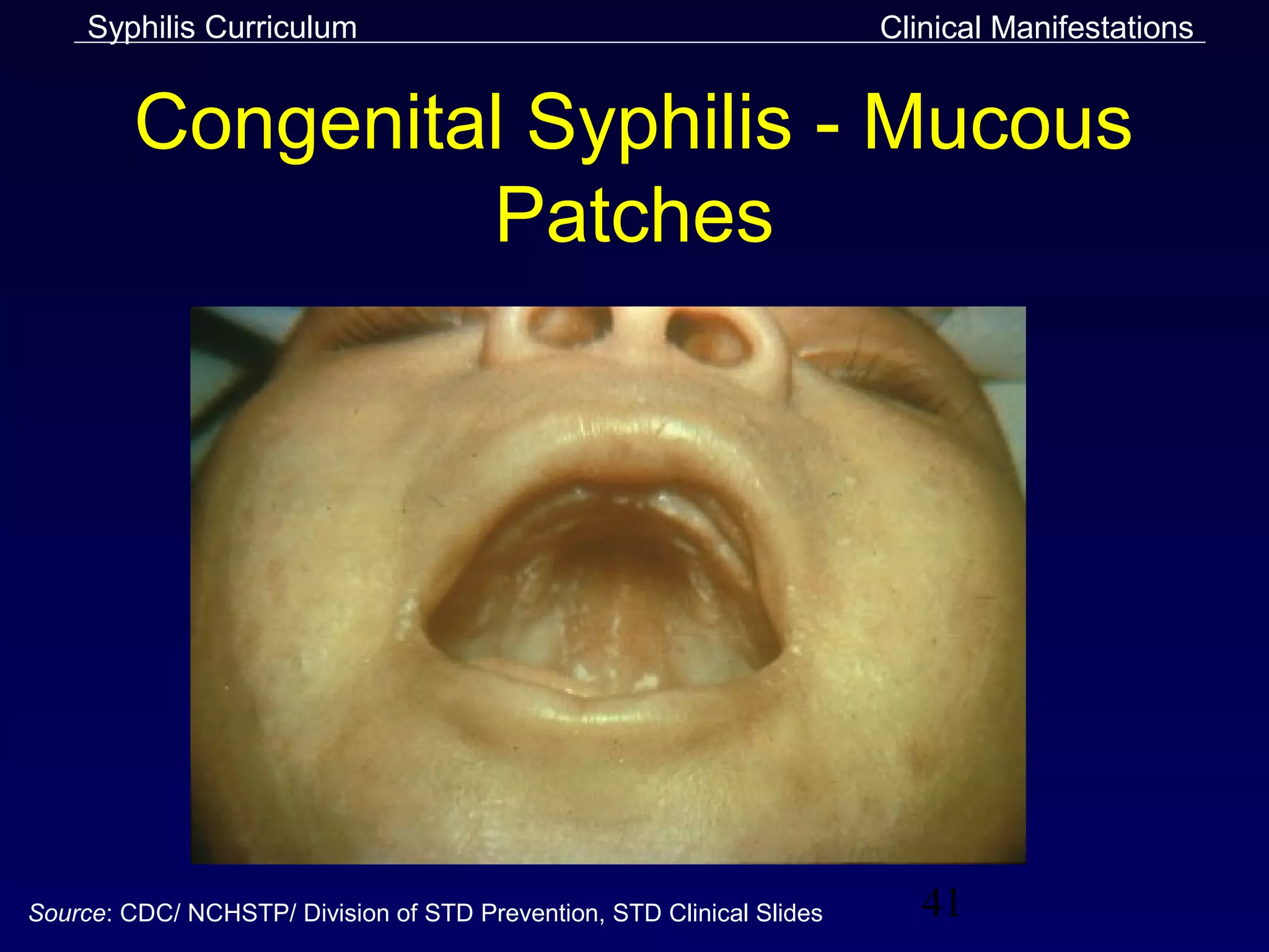 Syphilis slides | PPT