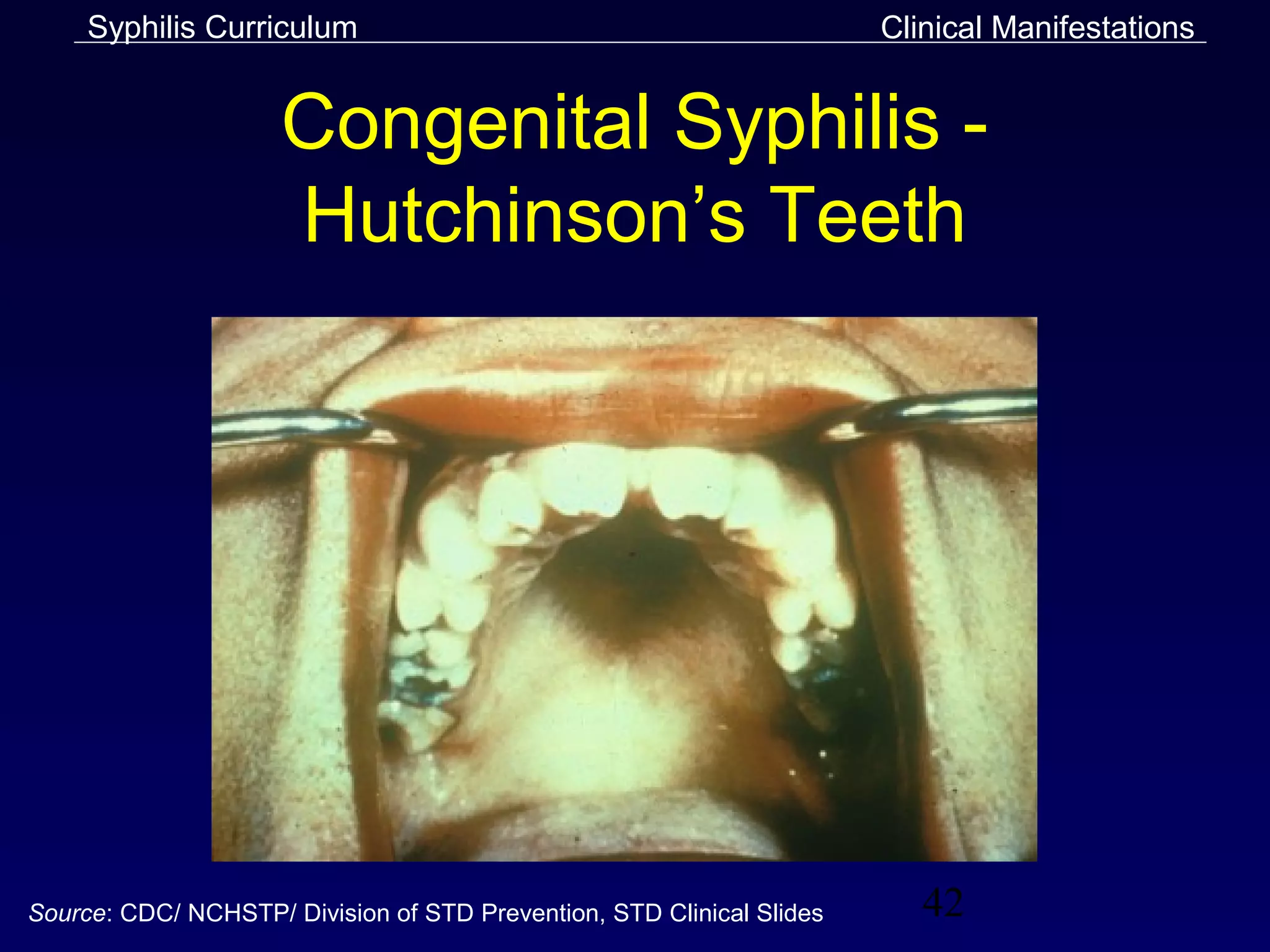 Syphilis slides | PPT