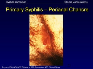 Syphilis slides | PPT