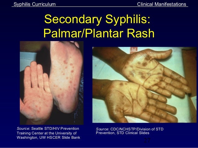Syphilis slides