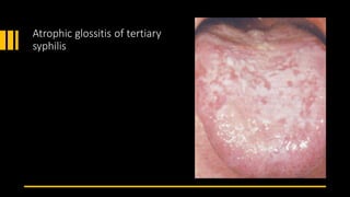 syphilis and its treatment prevention measurement | PPT