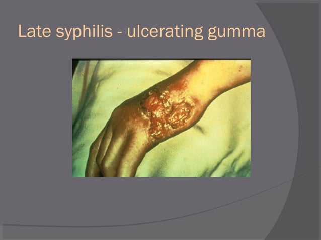 Syphilis (3) | PPT