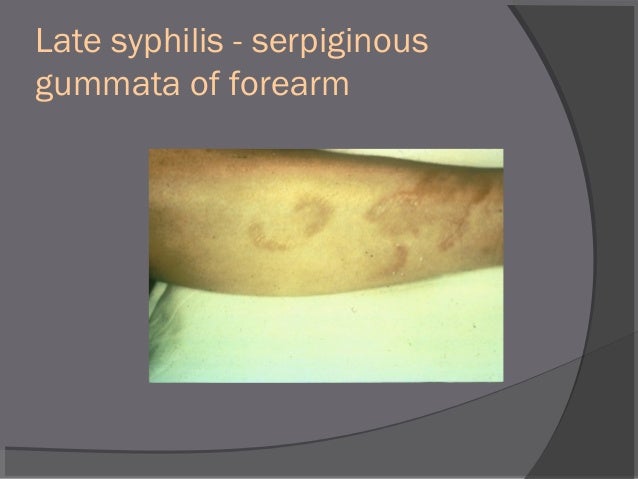 Syphilis (3)
