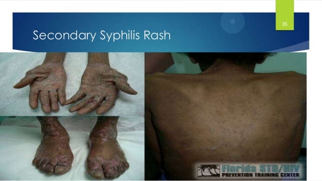 Syphilis by m yousry for undergraduates