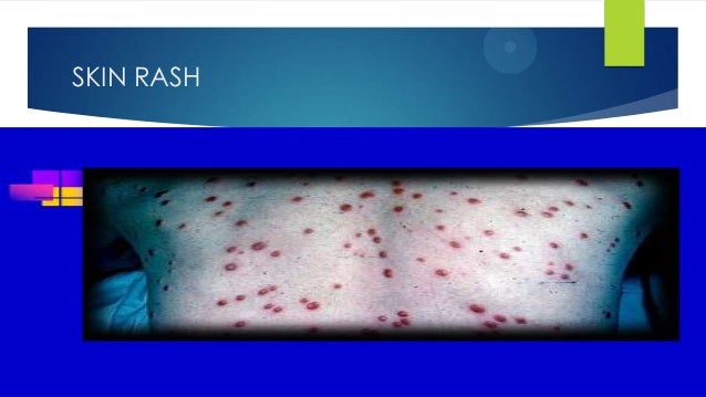 Syphilis by m yousry for undergraduates