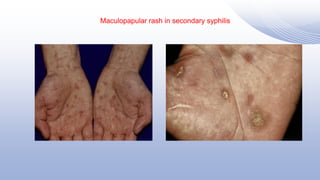 Syphilis Disease Edited.pptx , bacterium Treponema pallidum | PPT