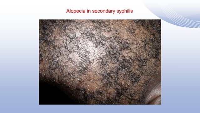 Syphilis Disease Edited.pptx , bacterium Treponema pallidum | PPT