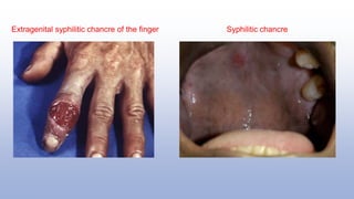 Syphilis Disease Edited.pptx , bacterium Treponema pallidum | PPTX