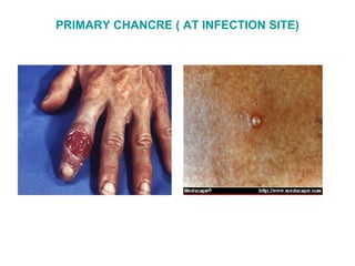 Syphilis in a nutshell | PPT