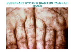 Syphilis in a nutshell | PPT