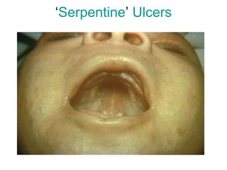 Syphilis in a nutshell | PPT