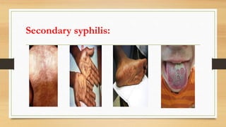 Syphilis lecture PP | PPTX