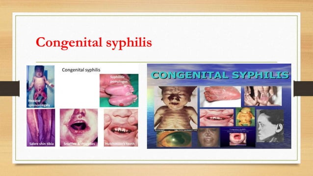 Syphilis lecture PP | PPT