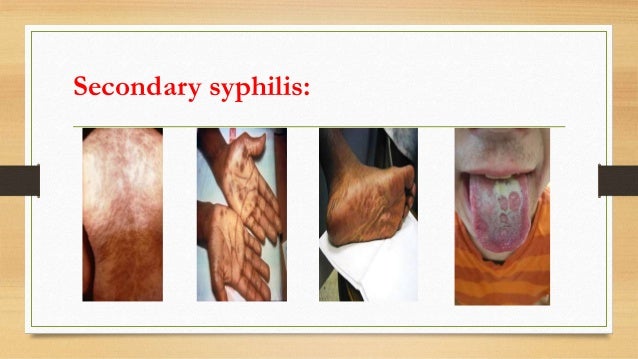 Syphilis lecture PP