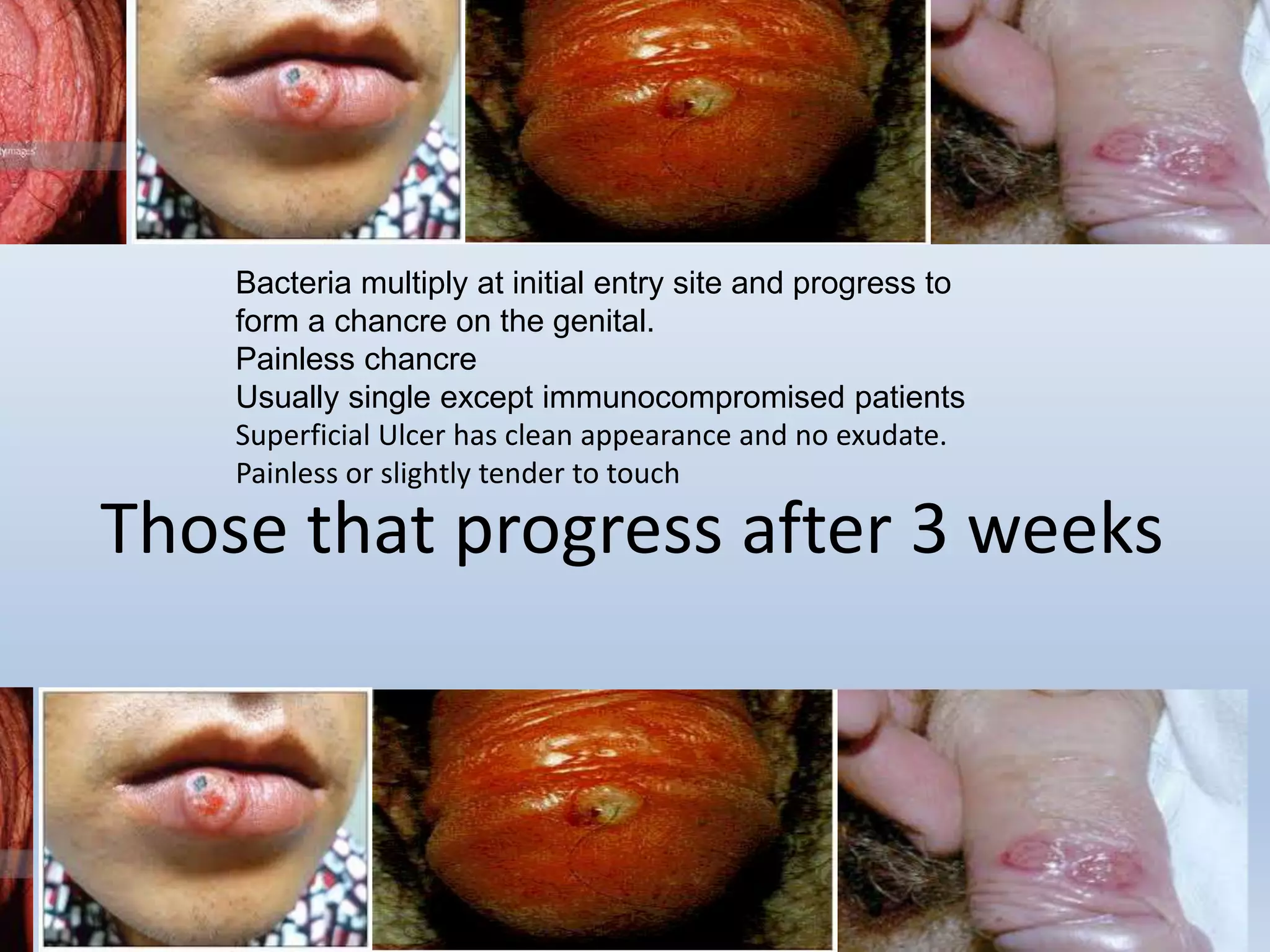 Syphilis new.pptx [repaired] | PPT