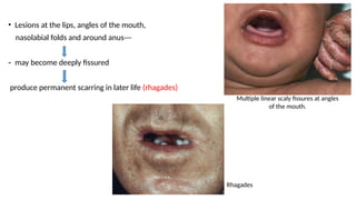 Syphilis in dermatology, clinical features | PPTX