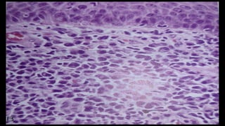 Syphilis complete notes on pathology mode of transmission and etiology ...