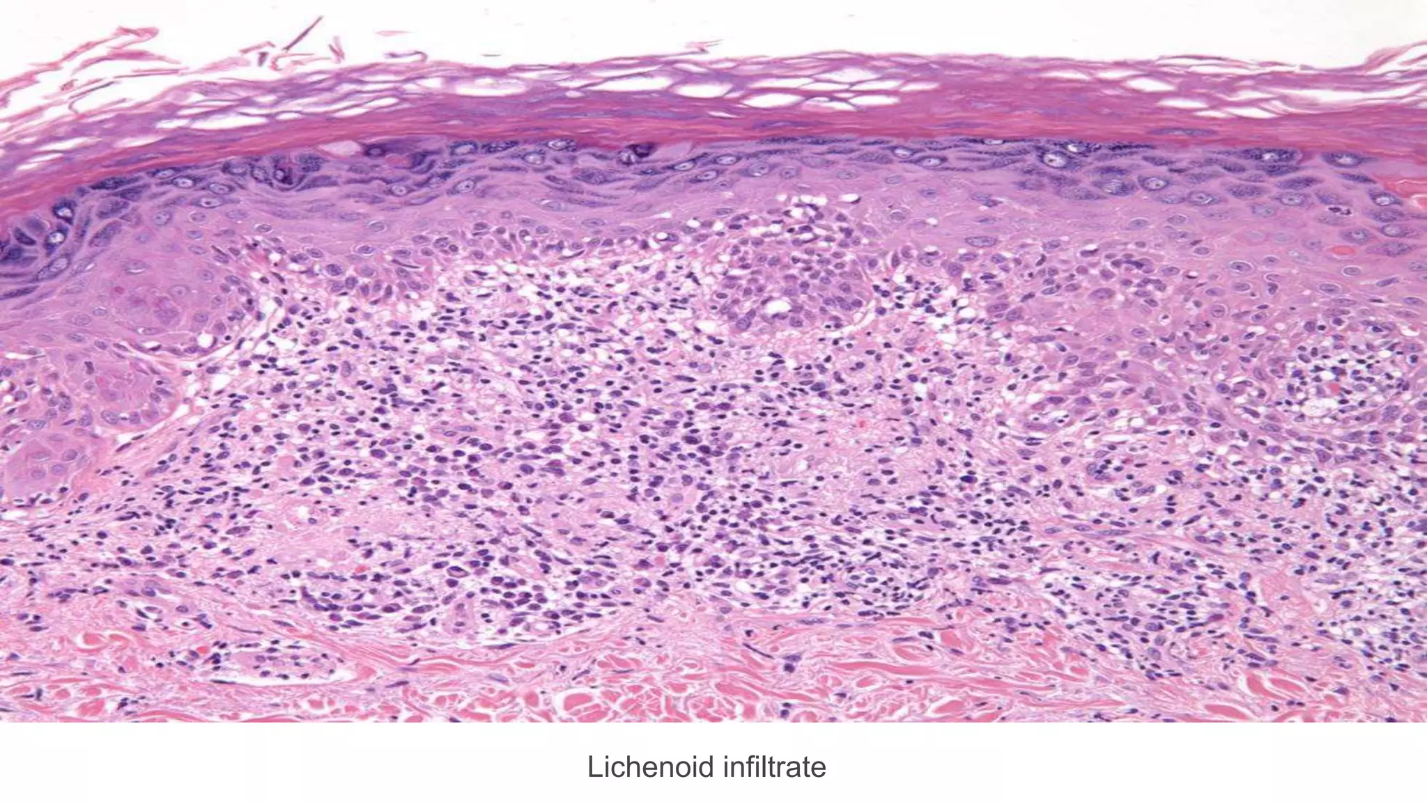syphilis serology ppt, syphilis, laboratory diagnosis of syphilis, VDRL ...