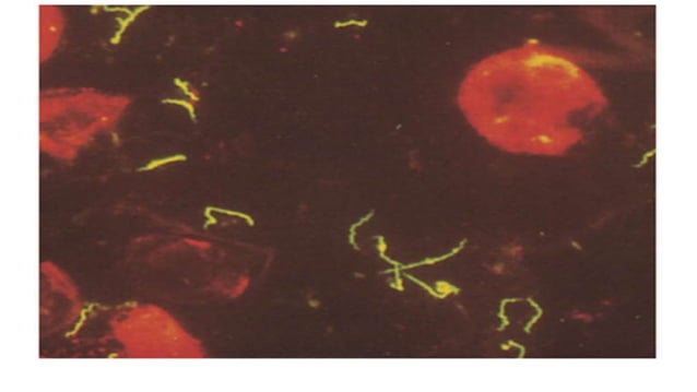 syphilis serology ppt, syphilis, laboratory diagnosis of syphilis, VDRL ...