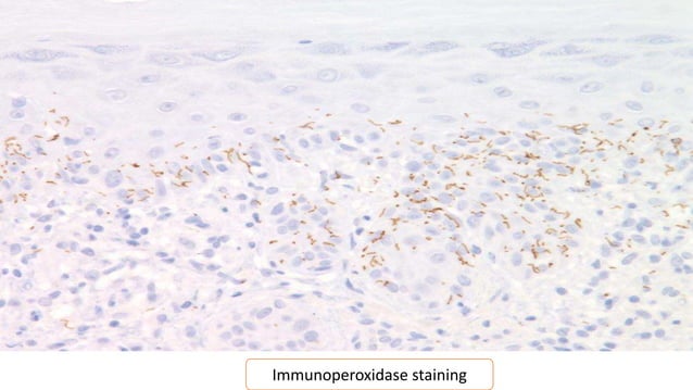 syphilis serology ppt, syphilis, laboratory diagnosis of syphilis, VDRL ...