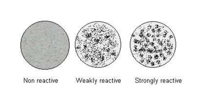 syphilis serology ppt, syphilis, laboratory diagnosis of syphilis, VDRL ...