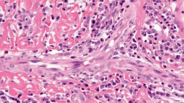 syphilis serology ppt, syphilis, laboratory diagnosis of syphilis, VD…