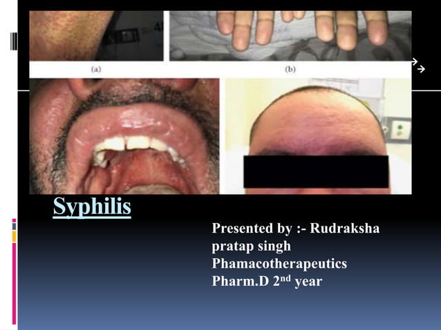 Syphilis Ppt Pptx