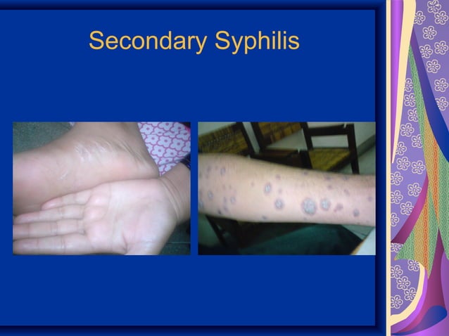 Syphilis resurgence: The social background | PPT