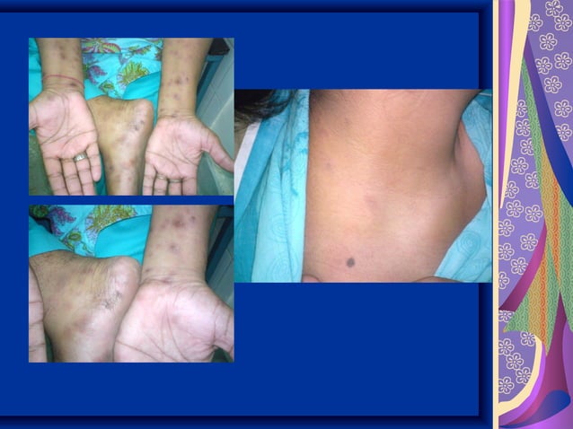 Syphilis resurgence: The social background | PPT