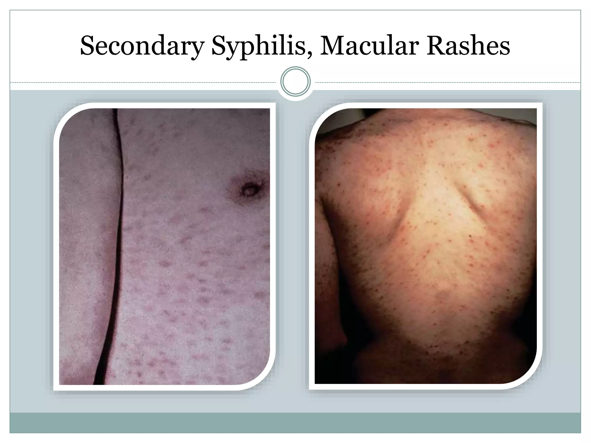 Syphilis | PPTX