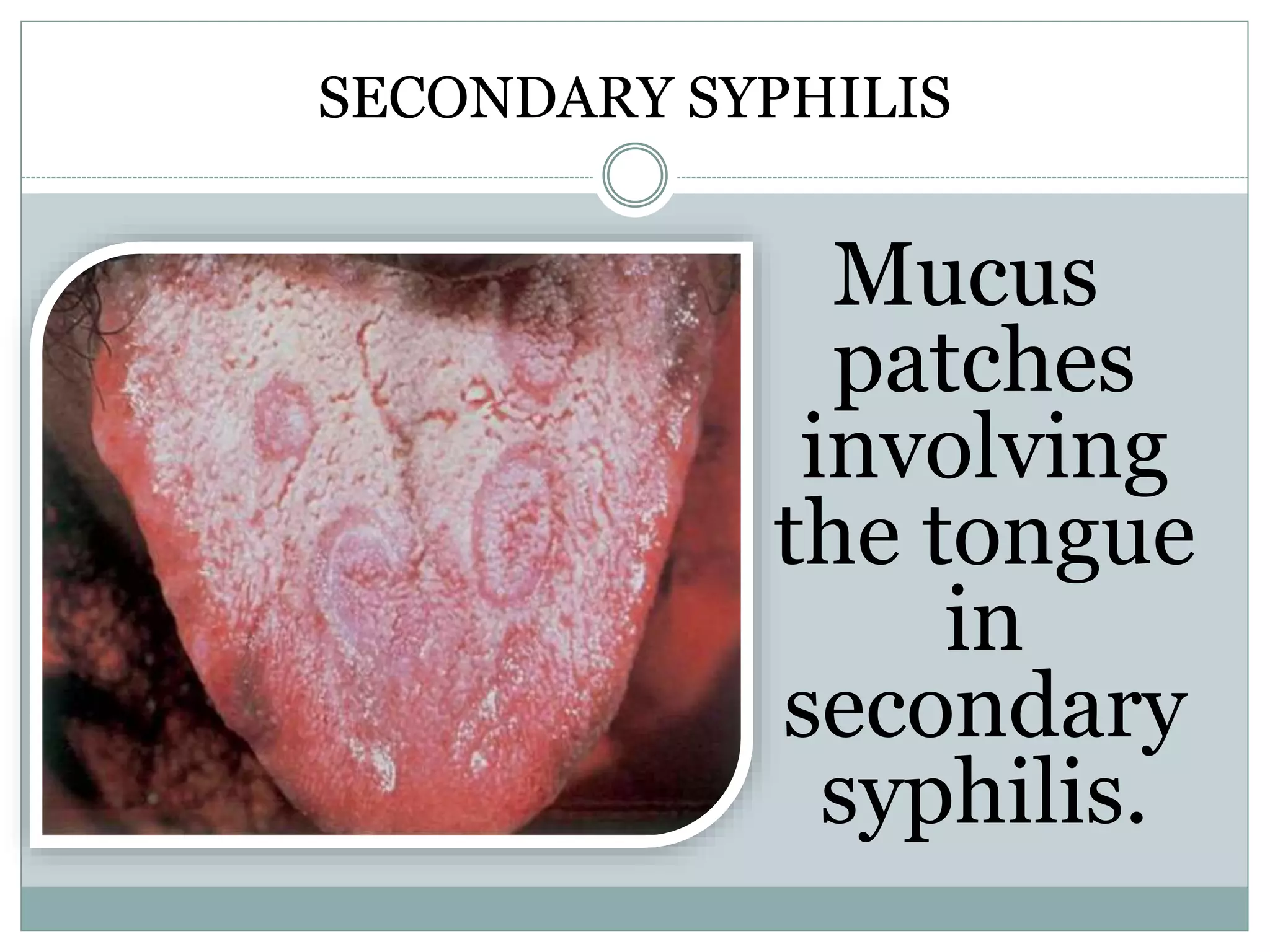Syphilis | PPT
