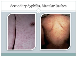 Syphilis | PPT