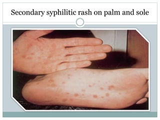 Syphilis | PPT