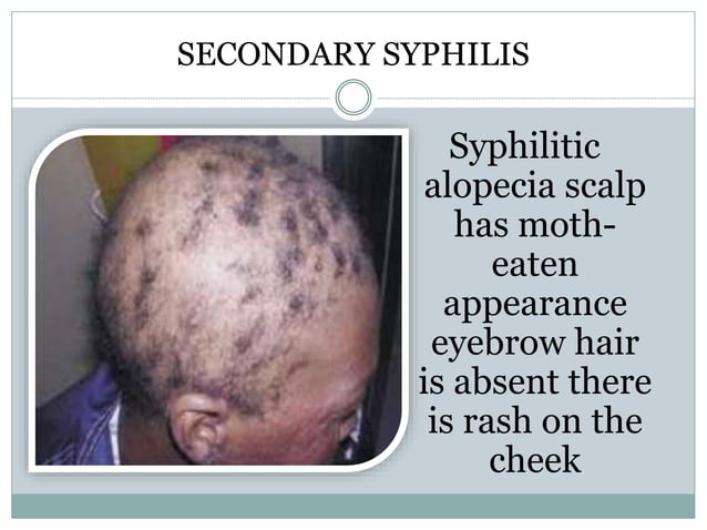 Syphilis | PPT