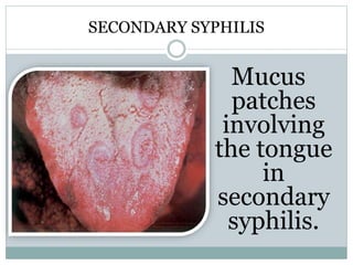 Syphilis | PPT