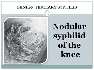 Syphilis | PPT
