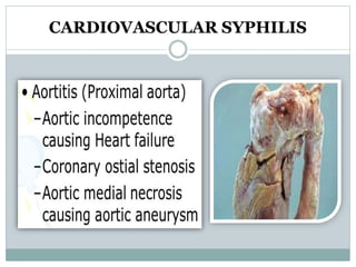 Syphilis | PPT