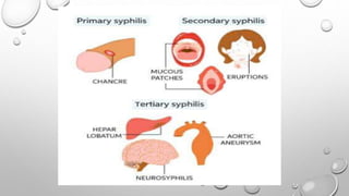 Syphilis | PPTX