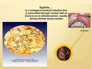 Syphylis | PPTX