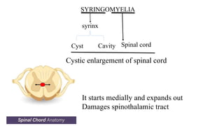 syrengomyelia /cystic enlargement / syrinx .pptx | Death, Injury, or ...
